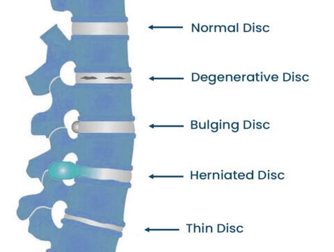 Slipped (Herniated) Disc Symptoms