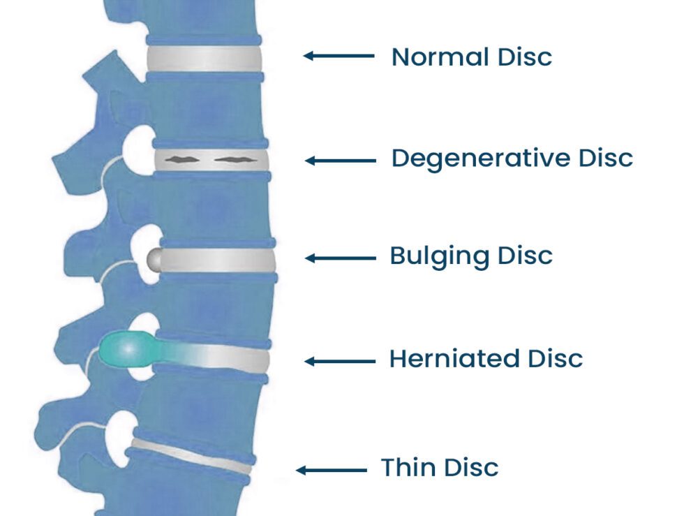 Slipped (Herniated) Disc Symptoms
